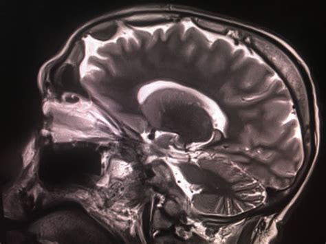 Arachnoid Granulation Radiology Imaging Neurology Radiology