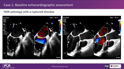 Advancing Valve Repair Mastering Diverse Mitral And Tricuspid Regurgitation Anatomies With The