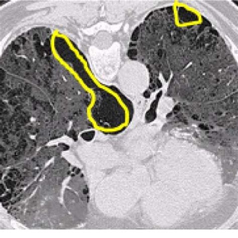 A Typical Hrct Scan Containing Emphysema The Regions Outlined Denote