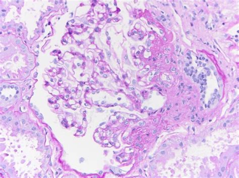 Glomerular Diseases Archives Page 2 Of 2 American Society Of Pediatric Nephrology ASPN