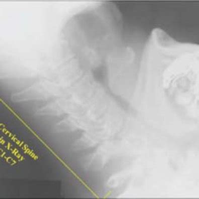 Cervical X Ray Dataset This Data Was Acquired From Digital X Ray Download Scientific Diagram