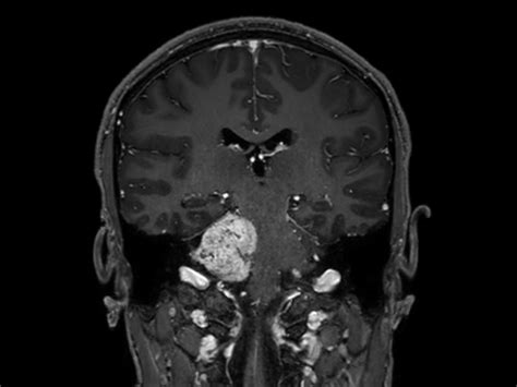 Brain Lesion With Multiband Sense Philips Mr Body Map