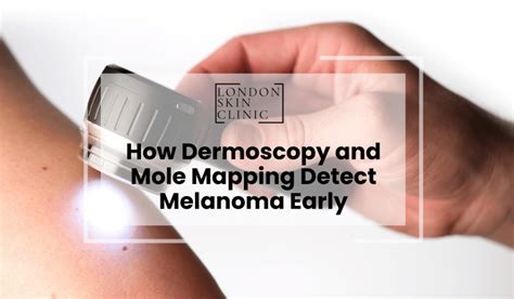 How Dermoscopy And Mole Mapping Detect Melanoma Early London Skin Clinic