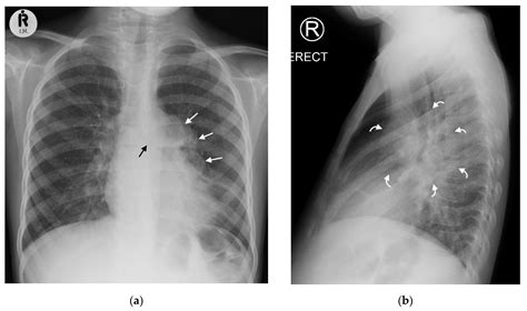 Chest Imaging For Pulmonary Tb—an Update