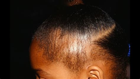 Fixing Damaged Hair Restoring Edges YouTube