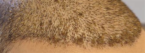 Why Are My Scabs So Slow To Go Away By Day Post Fue Hair Restoration Questions And