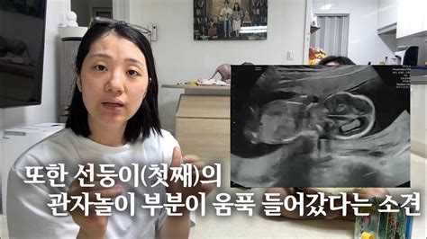 쌍둥이 임신 병원갈때마다 이상소견 듣고 있습니다 이번엔 뇌기형 신경관결손 의심 소견 Youtube