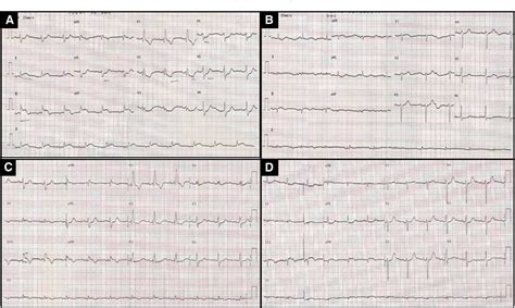 Figure 1 From Intermittent Right Bundle Branch Block Development In A Patent With Acute Inferior