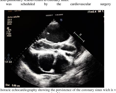 Figure 1 From Partial Anomalous Pulmonary Venous Return Associated With