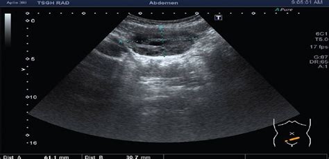 Borderline Malignancy Solitary Fibrous Tumor Of Abdominal Wa Formosan Journal Of Surgery