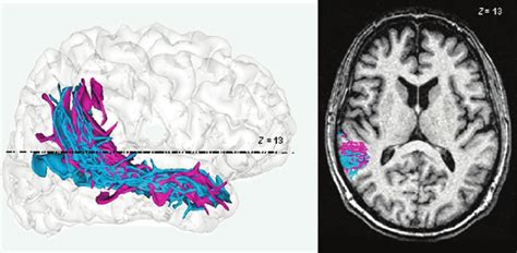 Superior Temporal Sulcus