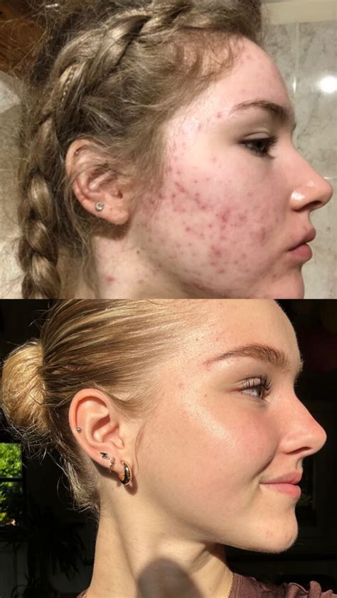 Do I Have Hormonal Acne Life With Mils