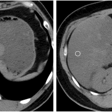 The Ratio Of Attenuation Values On Nonenhanced‐ct Between The Liver L