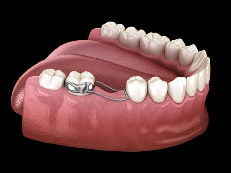 What Does A Spacer Do For Teeth