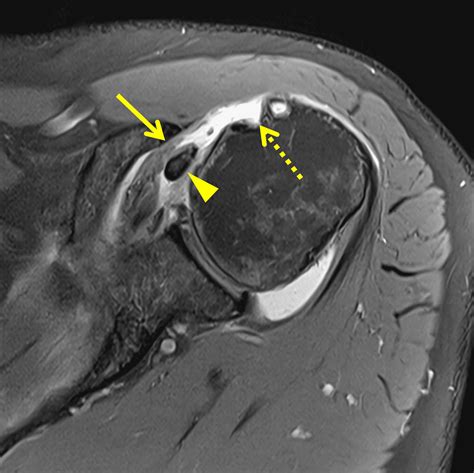 Subscapularis Tendon Tear Radsource