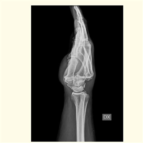 B Lateral View Of The Hand Showing Dorsal Dislocation Of Four Ulnar Download Scientific
