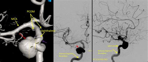 Internal Carotid Artery And Its Aneurysms