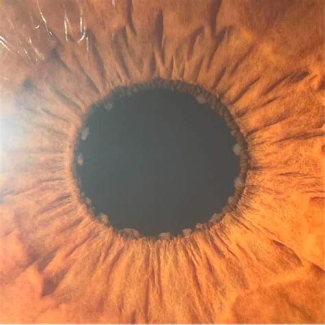 Koeppes Nodules ️koeppe Nodules Inflammatory Cell Precipitates Which Lie At The Pupillary