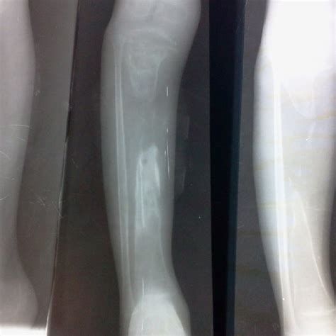 Pdf Tibialization Of Fibula In Treatment Of Major Bone Gap Defect Of