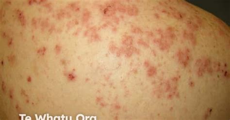 Nummular Dermatitis Image