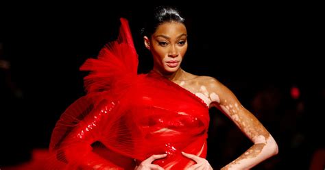 Día Mundial Del Vitiligo La Inspiradora Historia De La Modelo Que Es