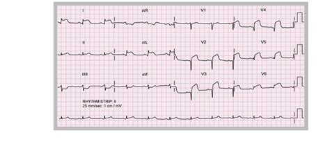 St Segment Elevation Strip