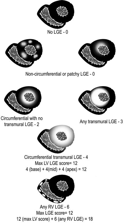 Schematic Representation Of Query Amyloid Late Enhancement Qale