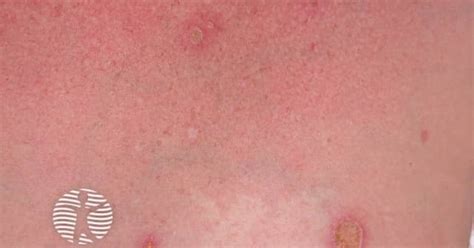 Ecthyma Image