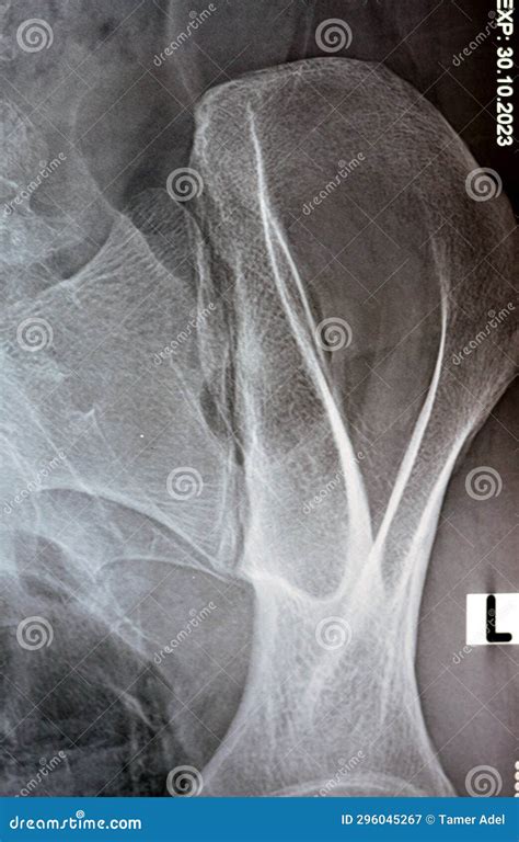 Sacroiliac Joint Digital Radiograph Examination X Ray Reveals Preserved