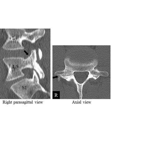 Bilateral L4 Pars Defect Arrows On Computed Tomography Ct A Download Scientific Diagram