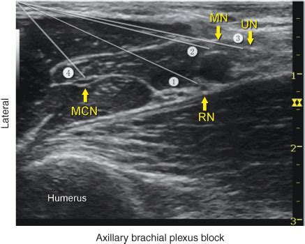 Ultrasound Guided Axillary Brachial Plexus Block Anesthesia Key