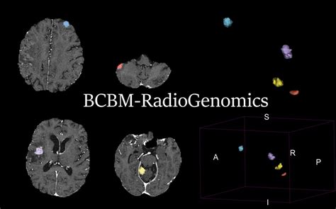 new dataset mri dataset of metastatic breast cancer to the brain with