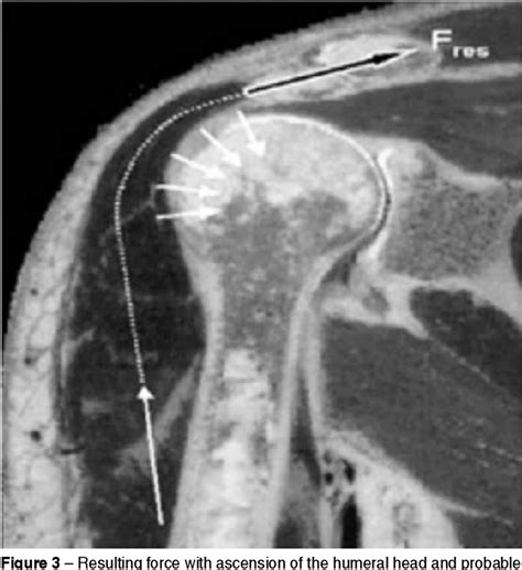 Figure 2 From Association Clinical Radiographic Of The Acromion Índex