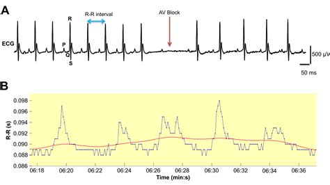 Simultaneous Video Eeg Ecg Monitoring To Identify Neurocardiac Dysfunction In Mouse Models Of