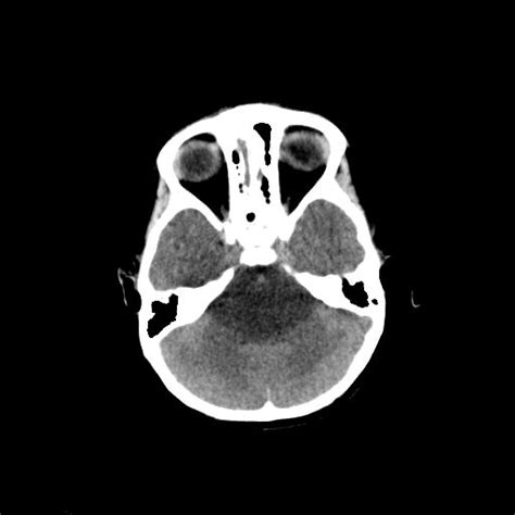 IRRADIATED Radiology DIFFUSE PONTINE GLIOMA