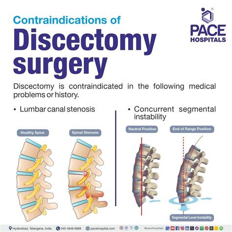 Discectomy In Hyderabad India Best Diskectomy Surgery