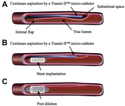 Aspiration After Sealing The Entrance By Stenting Is A Promising Method