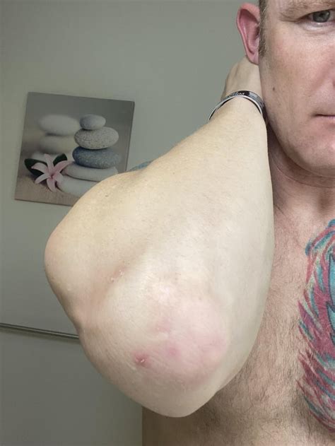 Wtf Is This Skin Nodules R Dermatologyquestions