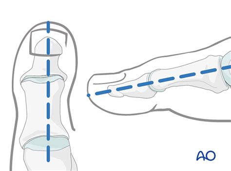 K Wire Fixation For Diaphyseal And Extraarticular End Segment Fractures Of The Proximal Hallux