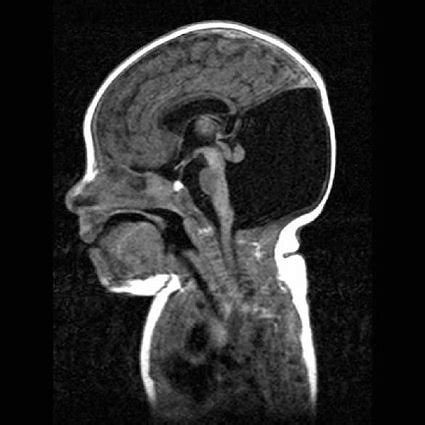 Dr Arun Lnaik Dandy Walker Syndrome
