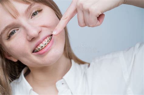 A Beautiful Red Haired Girl Smiles And Points To The Braces Young Woman Corrects Bite With