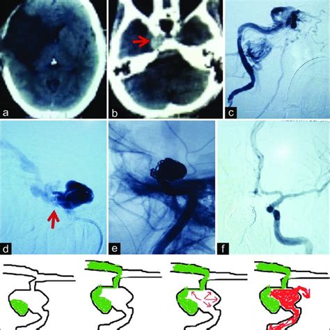 Ct Scan Of The Brain A And B Shows A Large Right Mca Infarct With Download Scientific Diagram