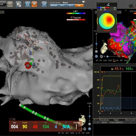 Radiofrequency Delivery With Very High Power Short Duration 90 W For Download Scientific