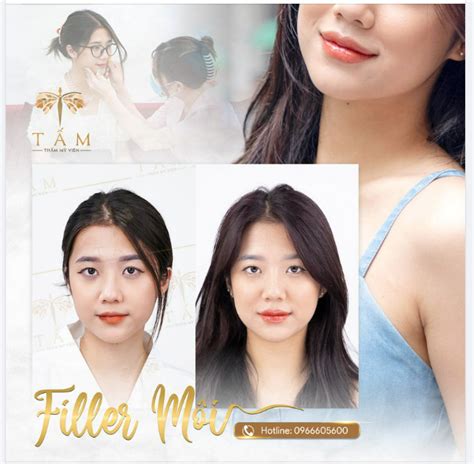 Môi xinh hé nụ cười xinh cùng Filler môi
