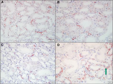 C4d Staining Along The Peritubular Capillaries Ptcs And In The