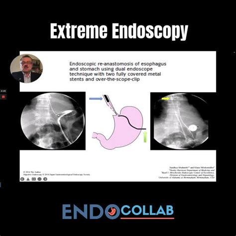 Endocollab™ Gi Endoscopy Education On Linkedin Extreme Endoscopy