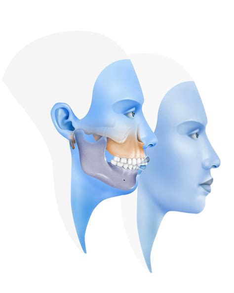 Clase Ii O Retrognatia Mandibular Cirugía Ortognática Instituto