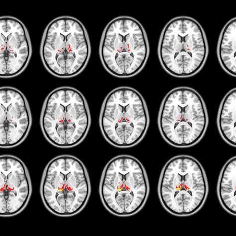 whole‐brain voxel‐wise binding potential bpnd maps and z‐score maps