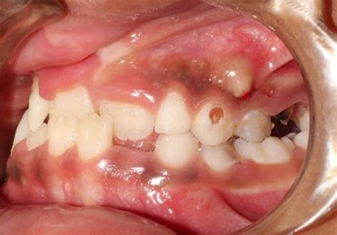 Maxillary Protraction And Preparation For Bone Graft Digital Workflows Fdi