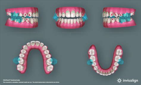Predicted Teeth And Jaw Positions Using Clincheck Software Download